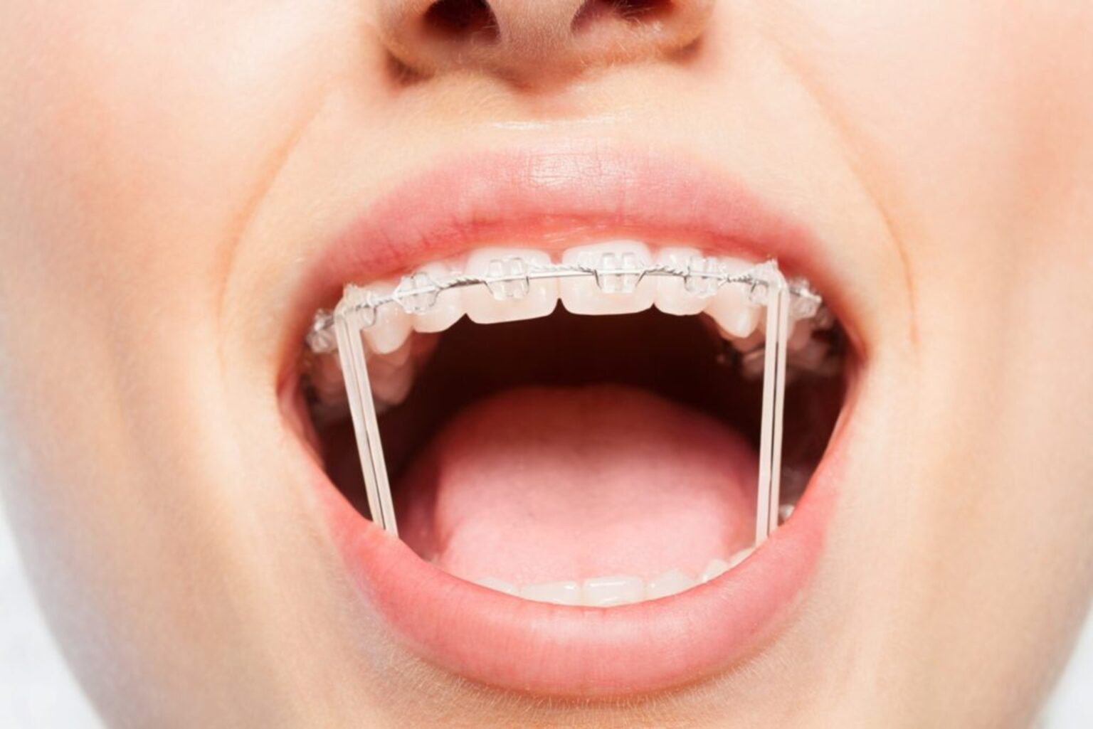 Rubber Bands on Braces | Reasons | Simply Orthodontics Milford