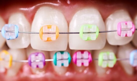Best Braces Rubber Band Colors | Simply Orthodontics
